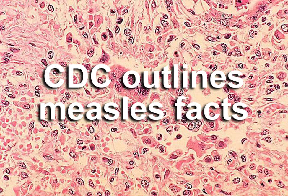 CDC outlines measles facts