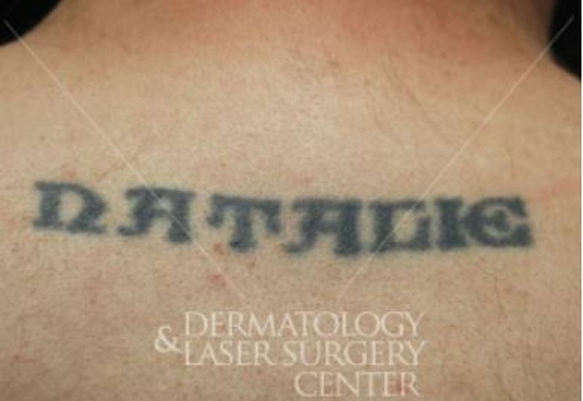 Tattoo removal increasing as regret sets in, particularly among millennials