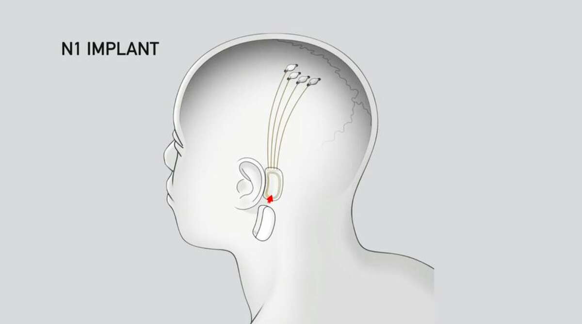 Elon Musk says Neuralink plans 2020 human test of brain-computer interface