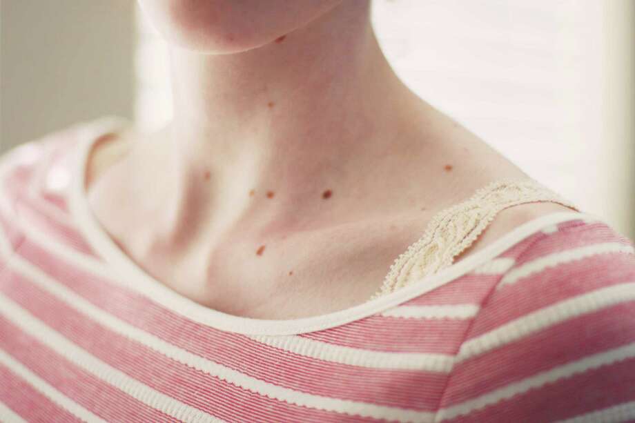 Raised Pinpoint Red Dots On Skin Foodsjoker
