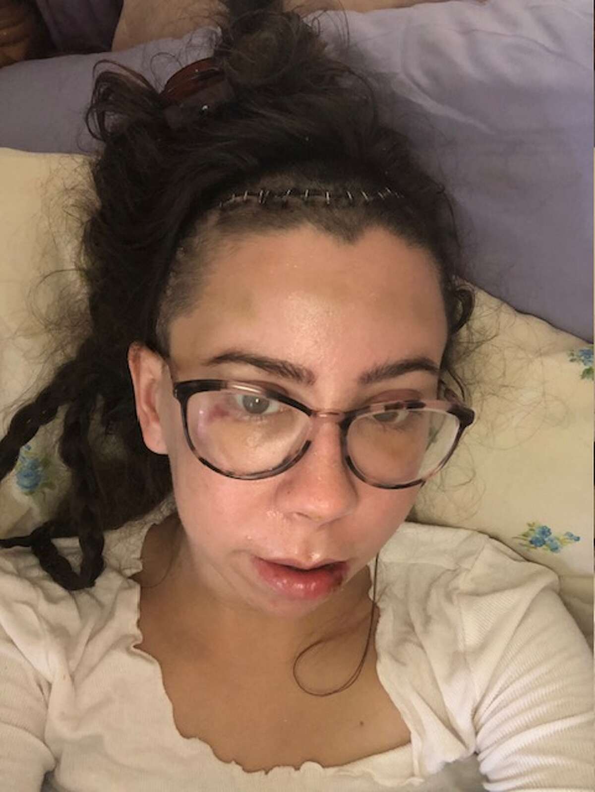 Houston plastic surgeon helps woman 'deformed' by assault