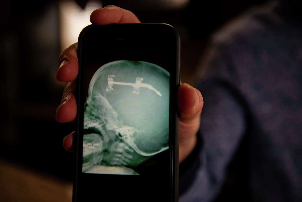 Baby Kate of Magnolia becomes the first child in Texas to undergo new ...