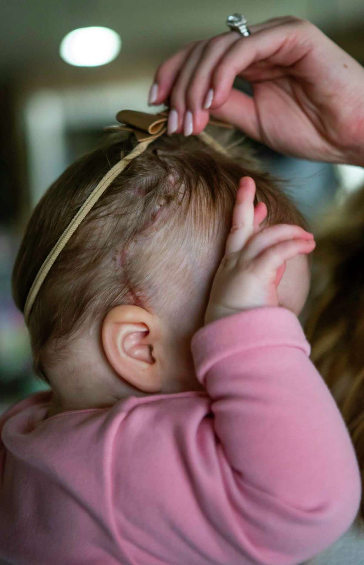 Baby Kate of Magnolia becomes the first child in Texas to undergo new ...