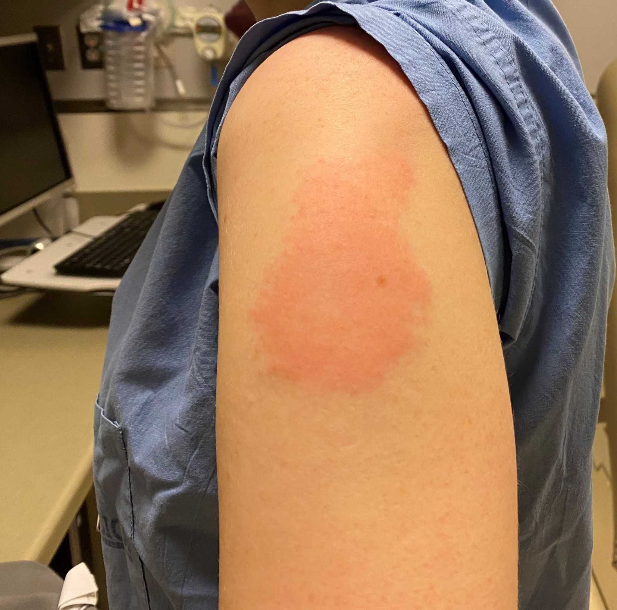 Researchers Report Delayed Skin Reaction To COVID 19 Vaccine Researchers Report Delayed Skin Reaction To COVID 19 Vaccine