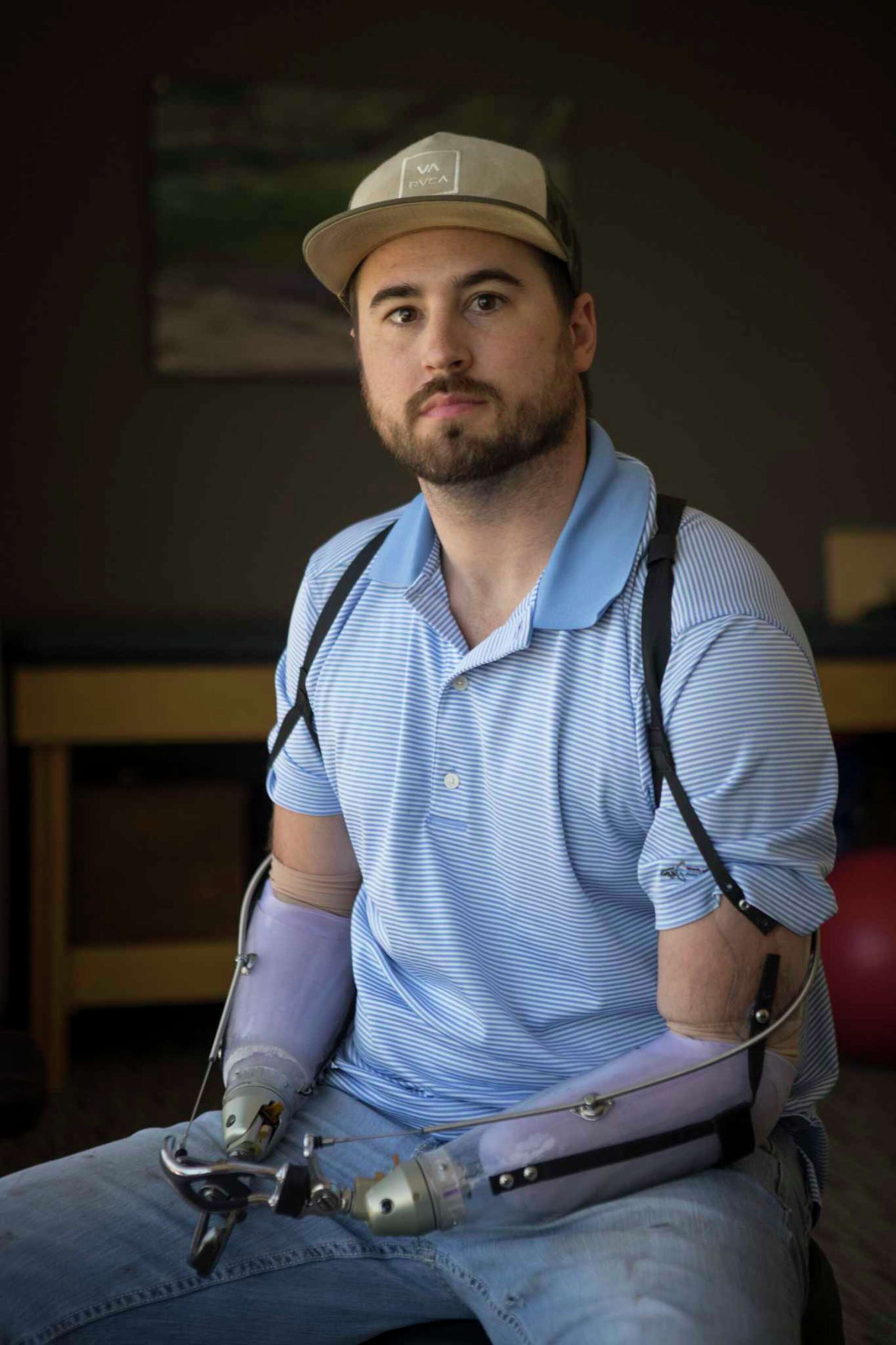 He had both hands amputated after an industrial accident. Now he's ...