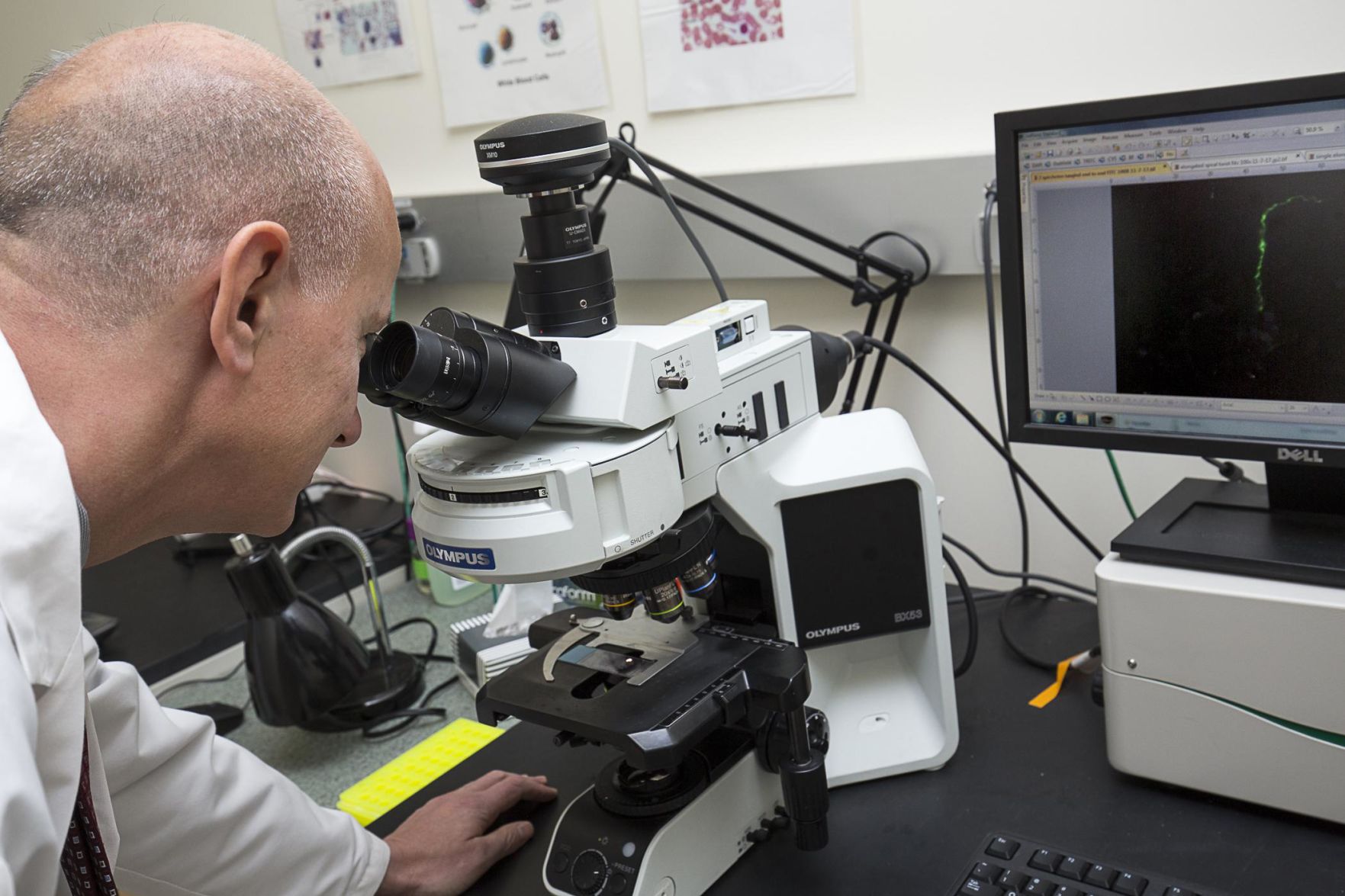 Lyme disease researchers hone diagnostic tools