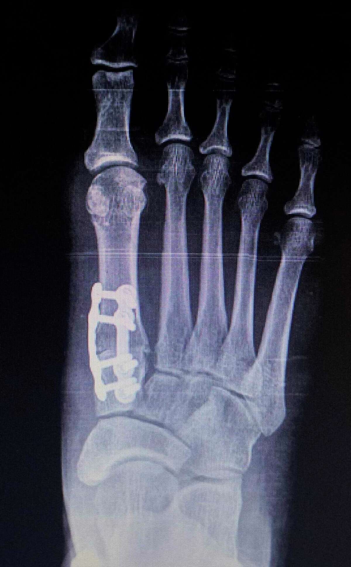 Got bunions? A Woodlands doctor offers an alternative to shaving them ...