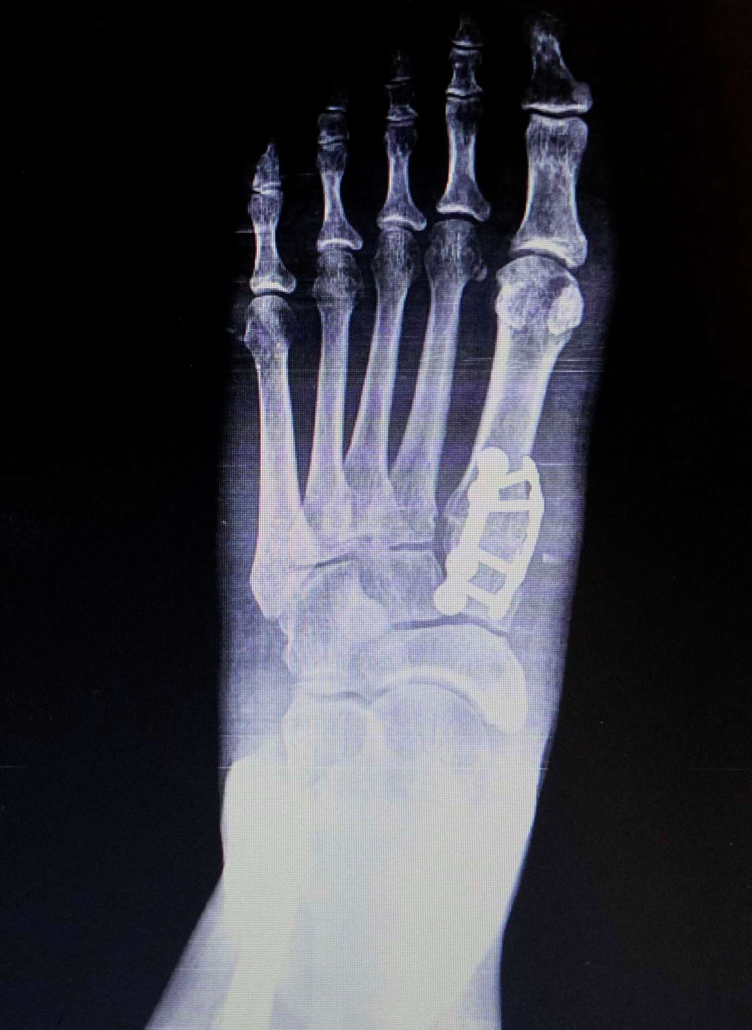 Got bunions? A Woodlands doctor offers an alternative to shaving them ...