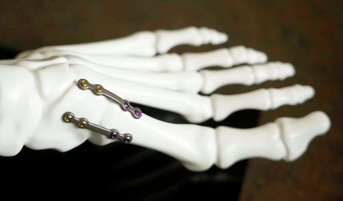 Got bunions? A Woodlands doctor offers an alternative to shaving them ...