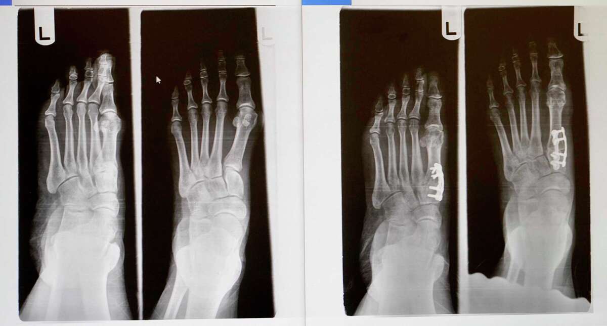 Got bunions? A Woodlands doctor offers an alternative to shaving them ...