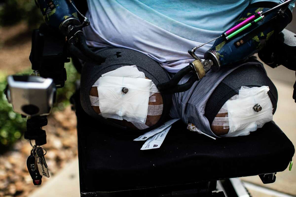 Rare procedure gives quadruple amputee a future with pain-free prosthetics