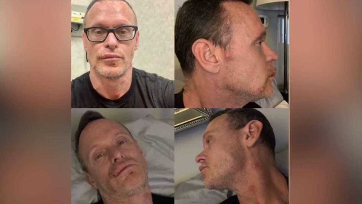 Man shares 'horrific' experience with monkeypox, struggle to get treatment