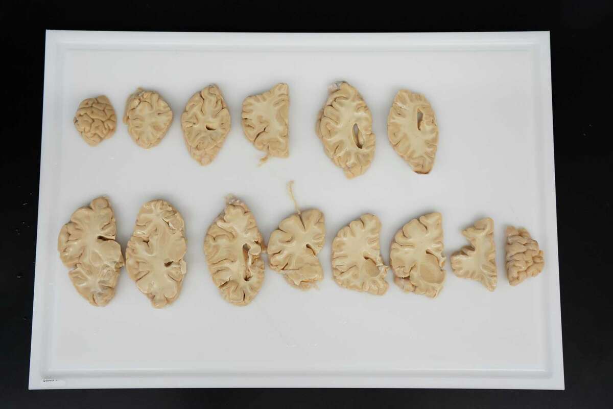 Researchers investigate drug addiction at Houston brain bank