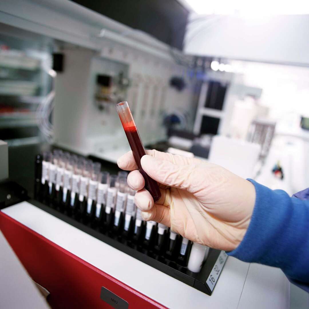 What Type of Blood Tests Are Used for Cirrhosis of the Liver?