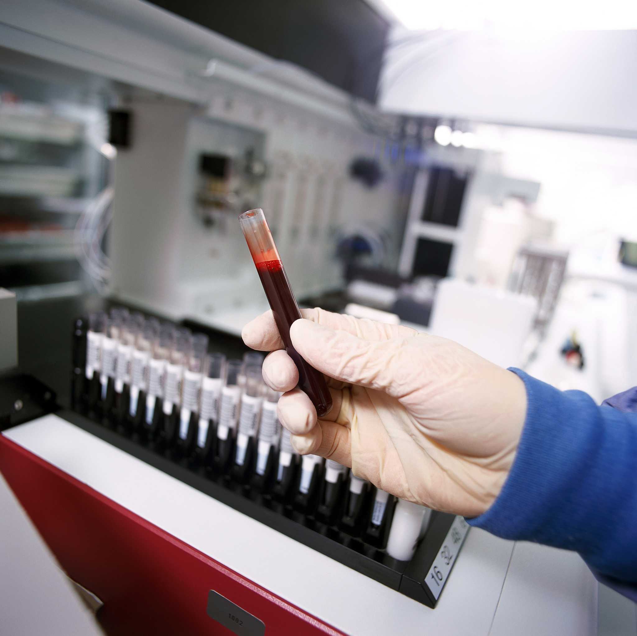 What Happens if a Mother Has an RH- Blood Type & the Fetus Has an RH+ ...