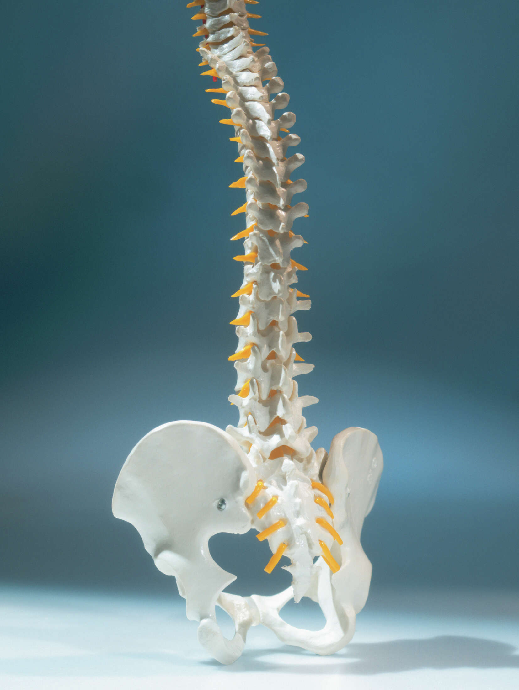 What Is the Pars Defect of the Lumbar Spine?