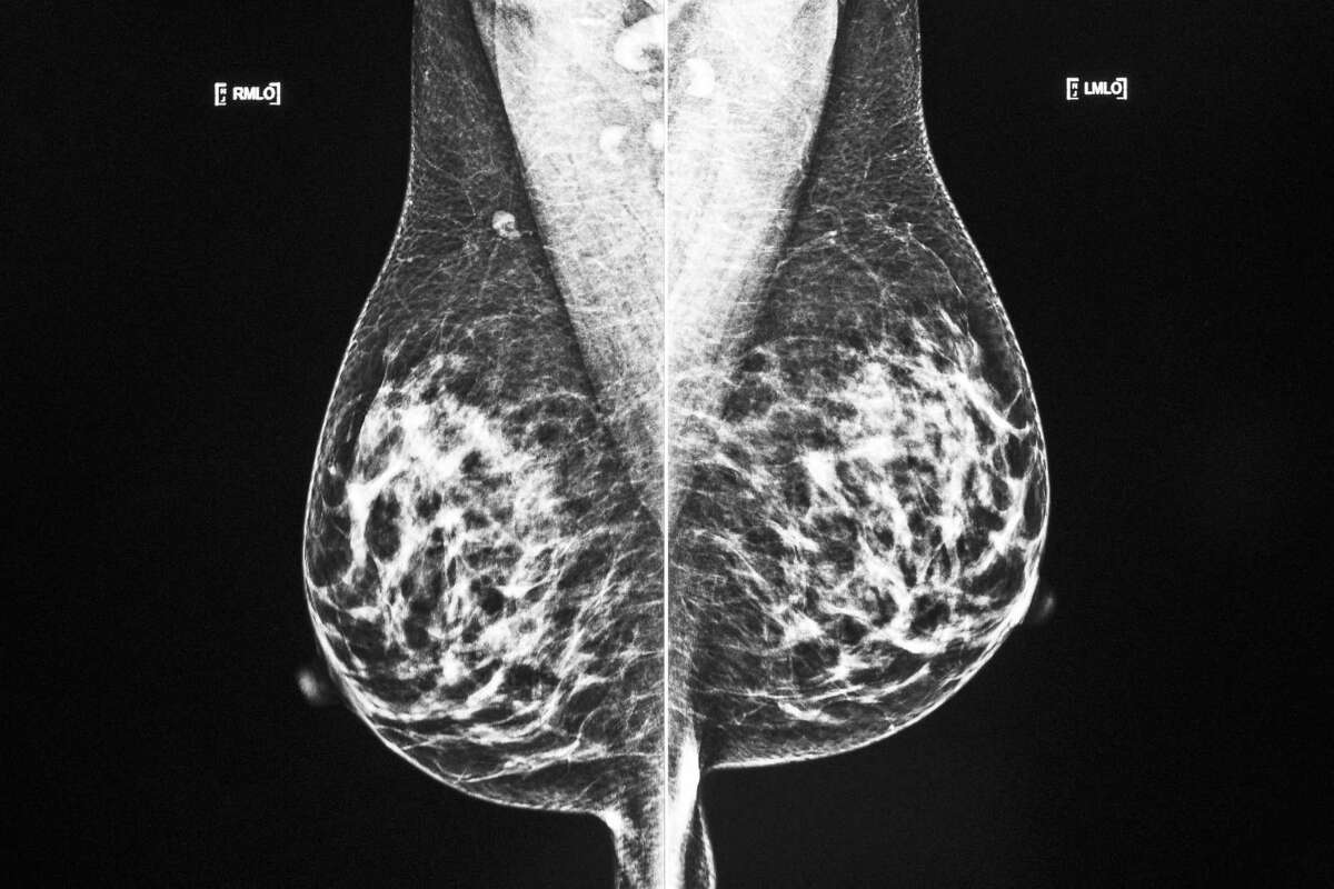 Mammograms Starting At 40 Are Costs Worth Potential Lives Saved