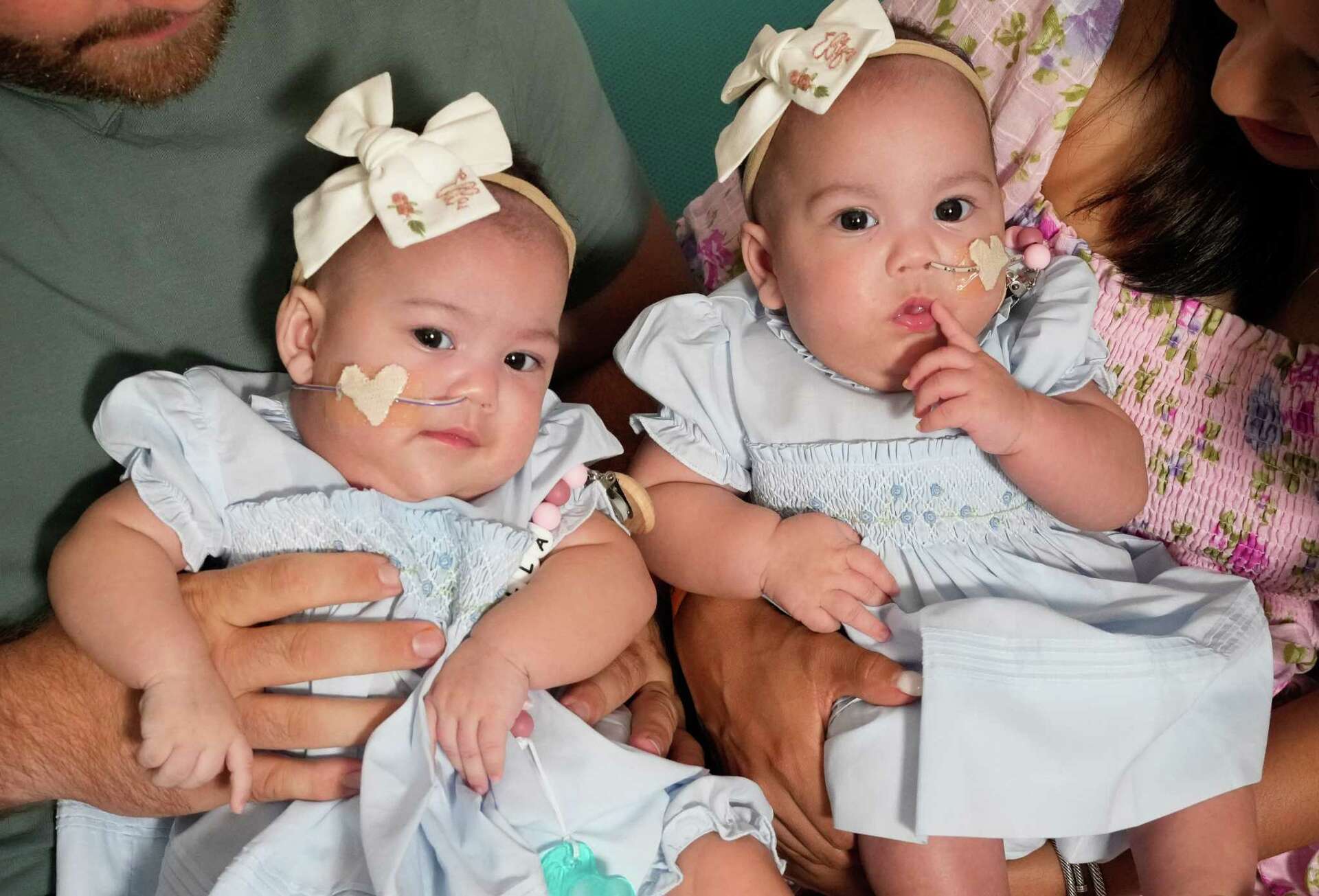 Conjoined twins successfully separated at Texas Children’s