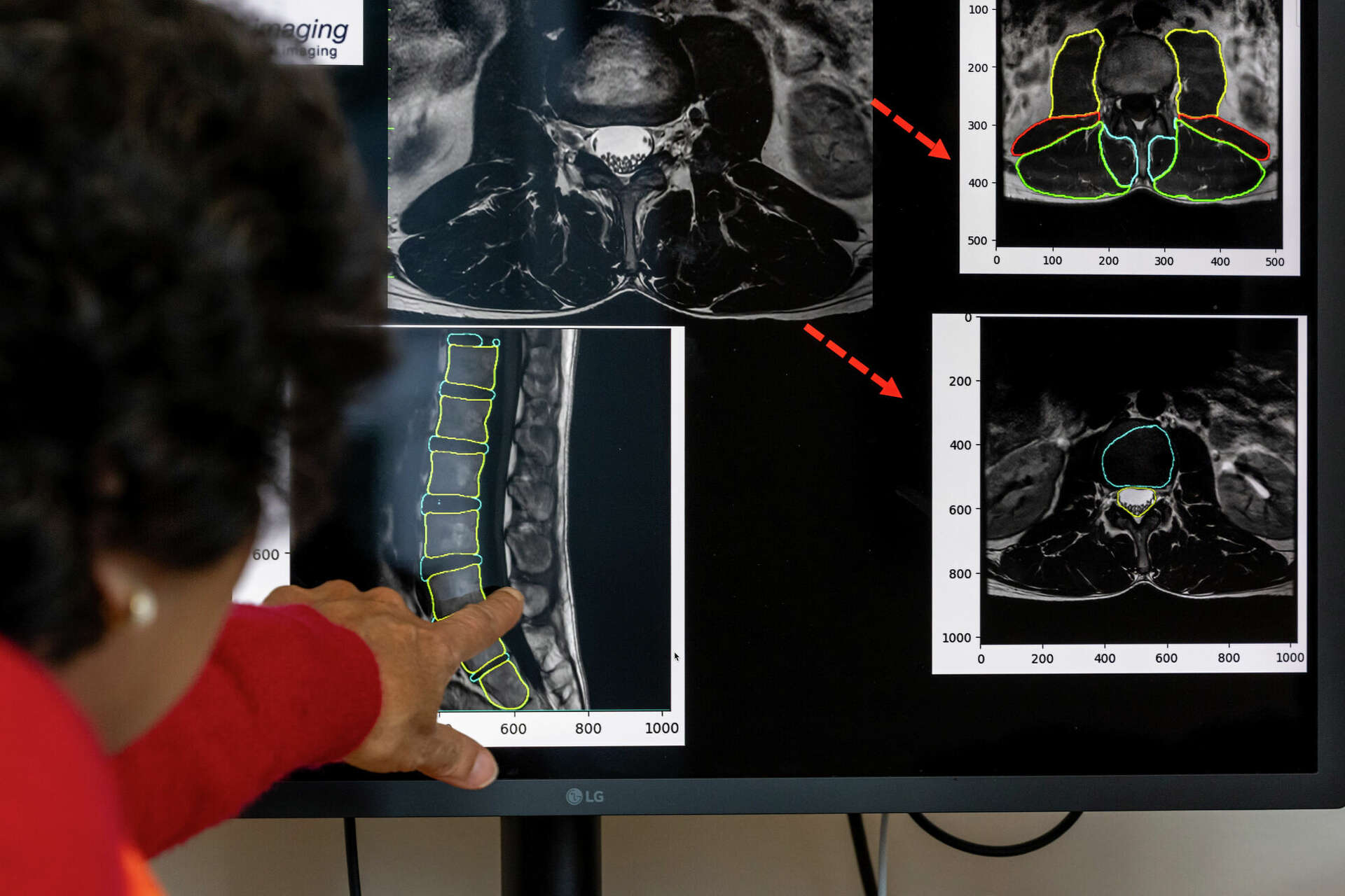 UCSF doctors use AI to make smarter diagnoses of lower back pain MRIs