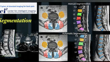 UCSF doctors use AI to make smarter diagnoses of lower back pain MRIs