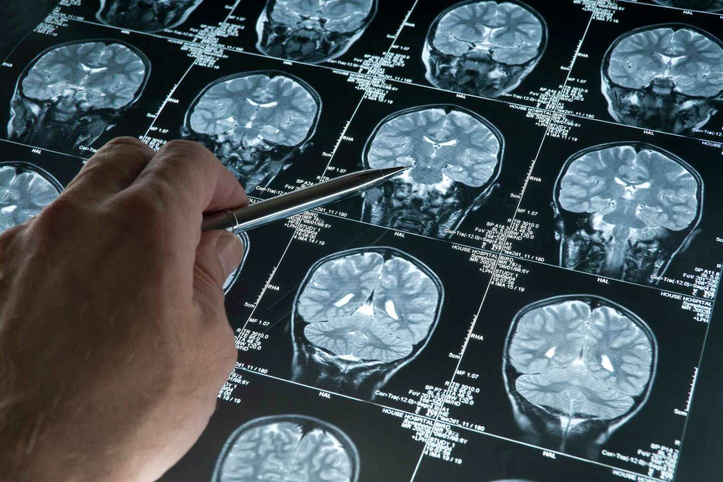 Human brains are getting bigger — and that could lower dementia risk
