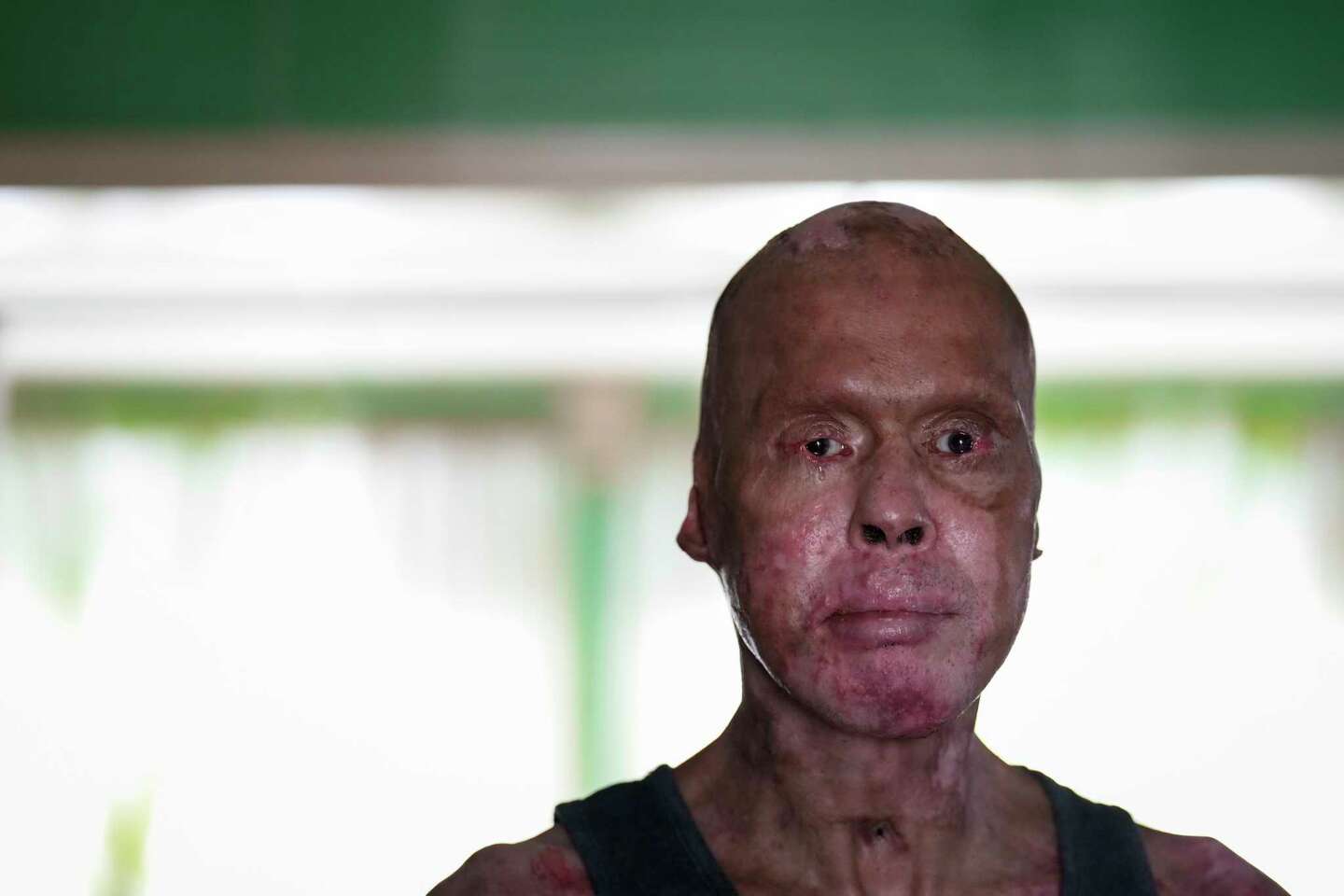 A faulty furnace. A blast of fire. And a man’s life, shattered