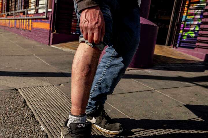 San Francisco drug users suffer from more than overdoses