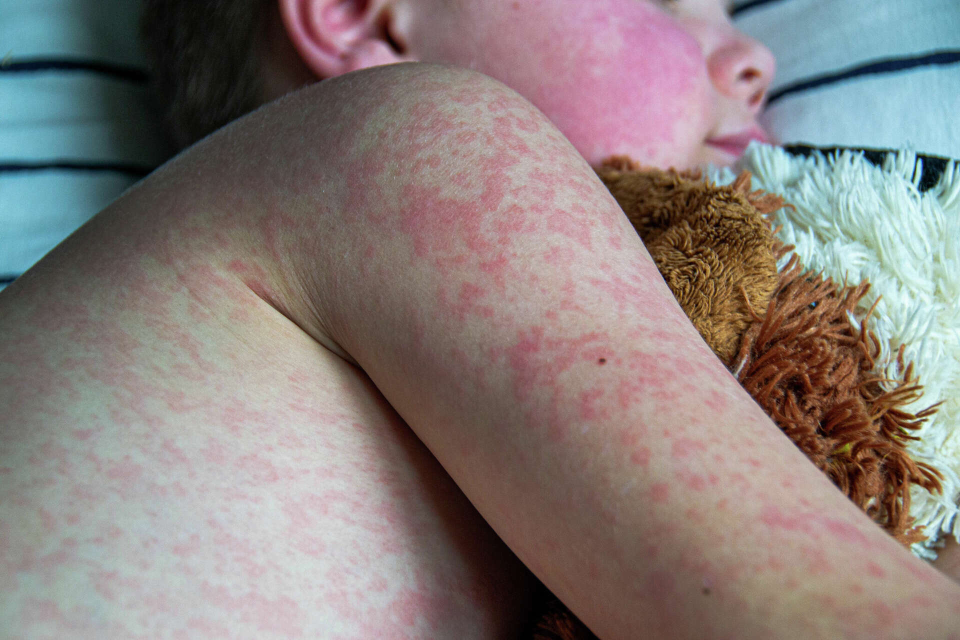 Measles surges in Texas as exposure spreads to San Antonio