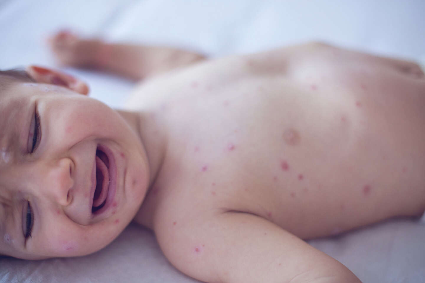 Texas measles cases rise to 327: What you need to know