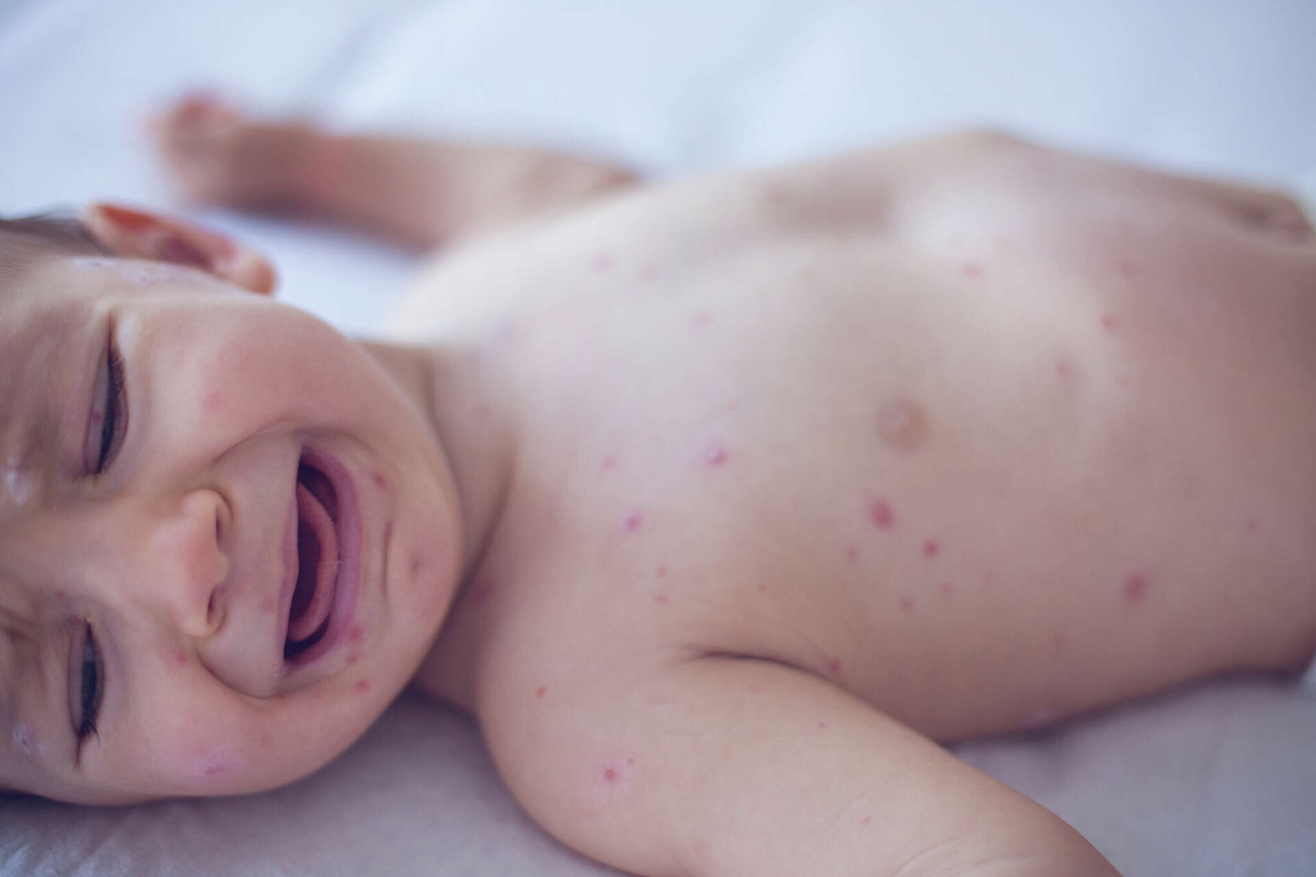 Texas measles cases rise to 327: What you need to know