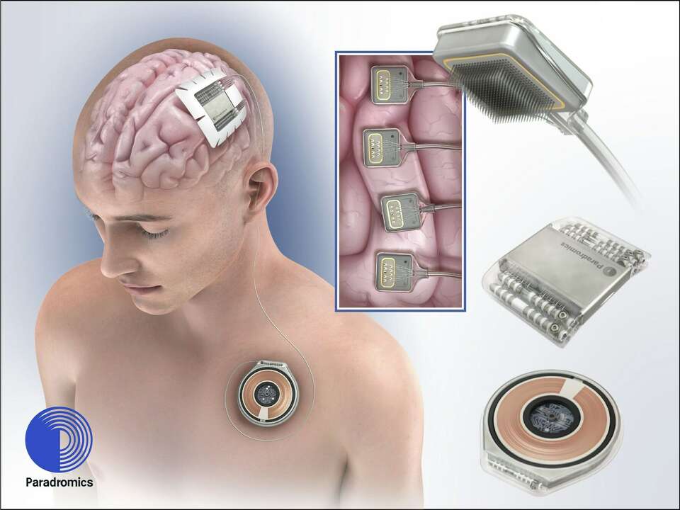 Austin competitor of Musk's Neuralink completed its first surgery