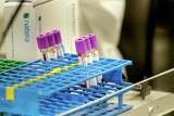 When will cancer return? Personalized Signatera blood test can find ...