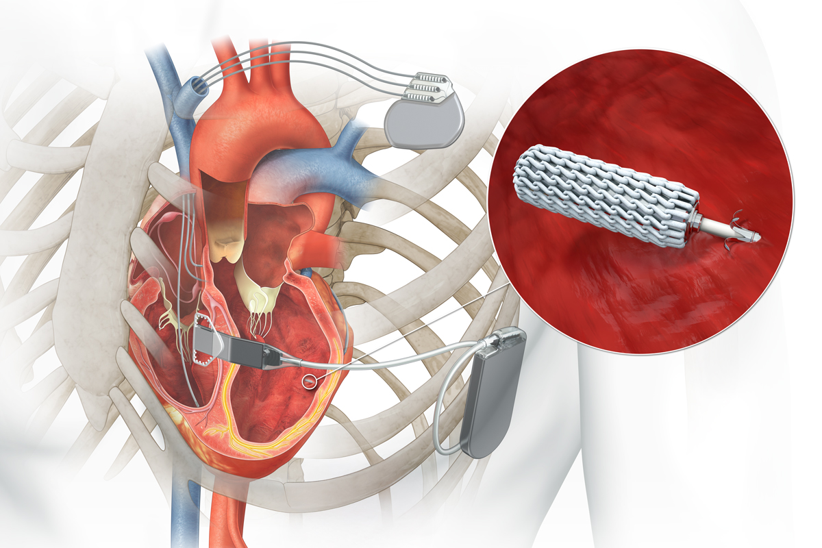 Austin implants first heart failure device to keep better heart rhythm