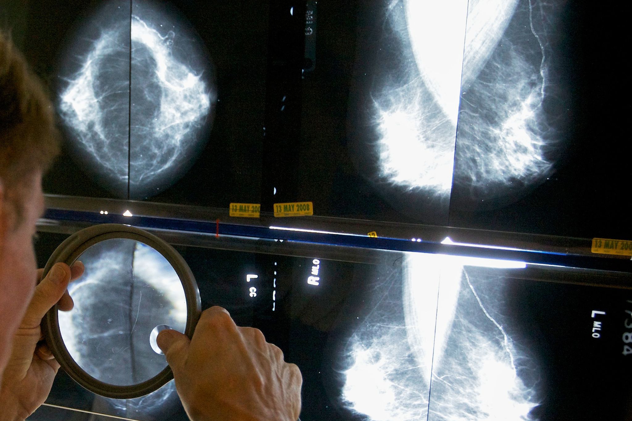 Pandemic disruptions to health care worsened cancer survival, study ...