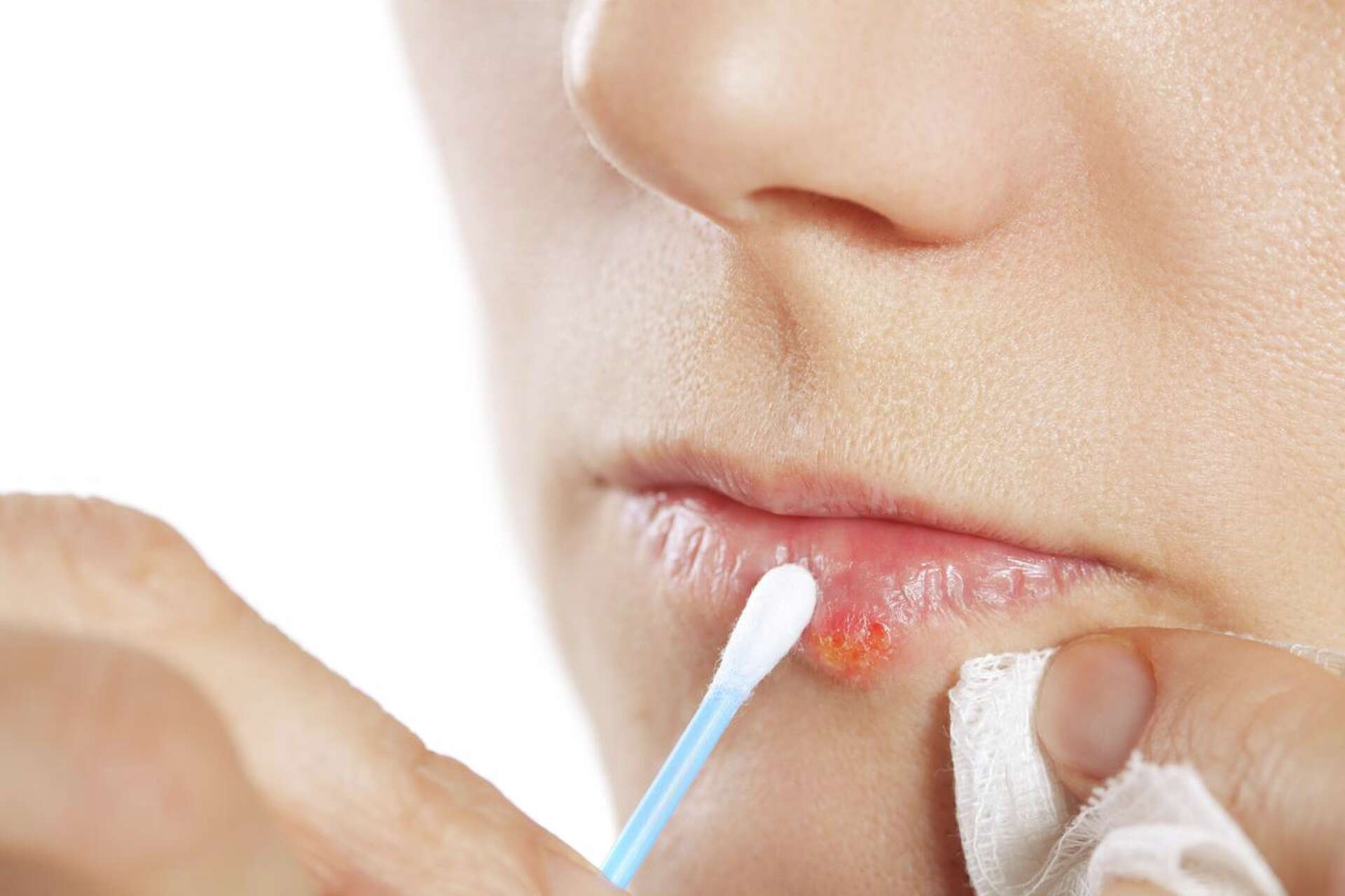 Por qué brotan ampollas en los labios y cómo eliminarlas