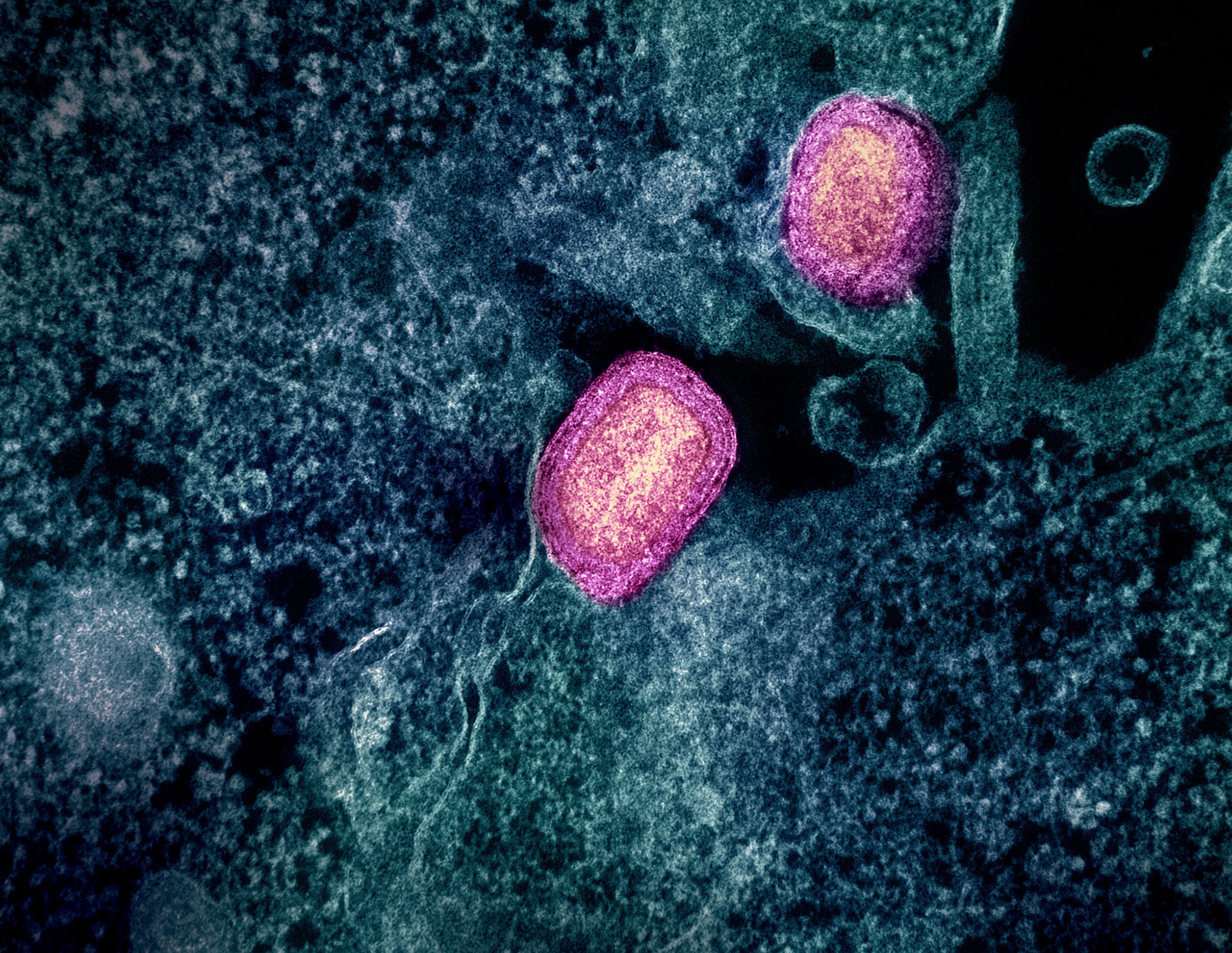 SF: Health Officials Urge Vaccinations After New Case Of Monkeypox Reported