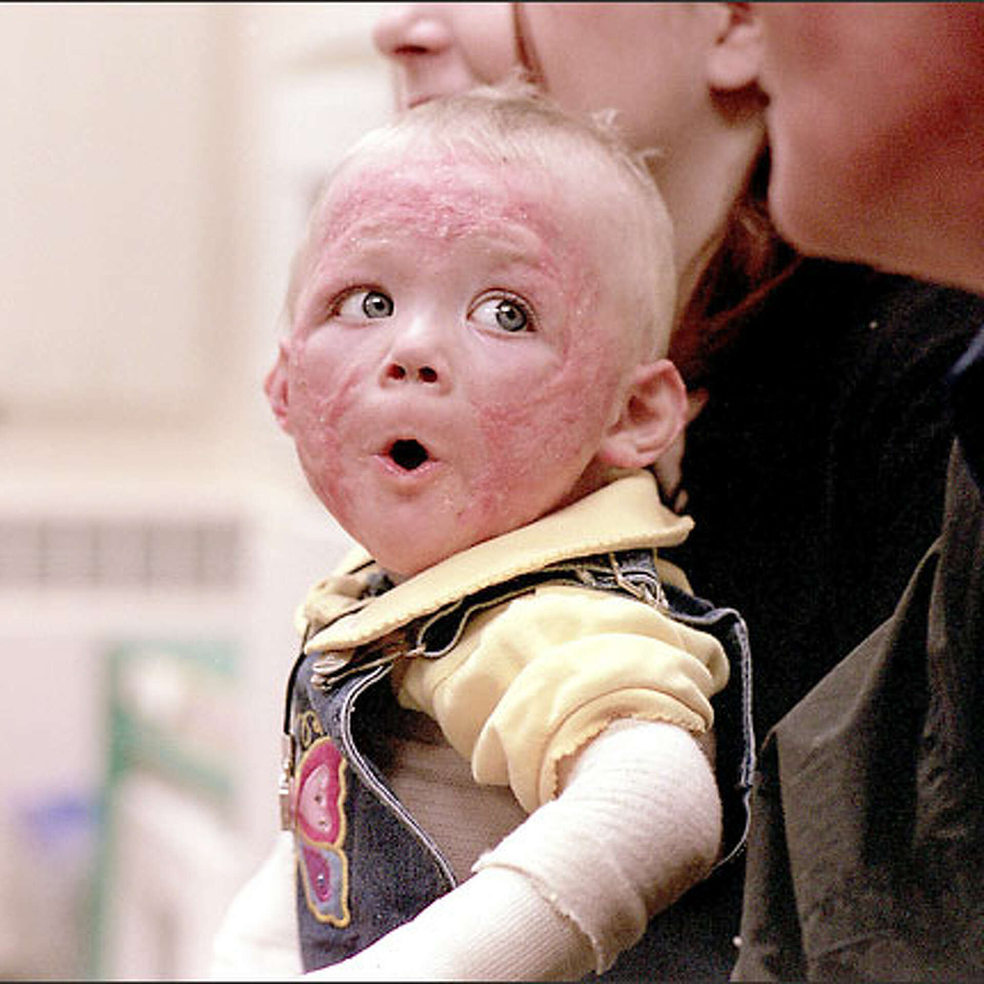 Spirited toddler begins to heal