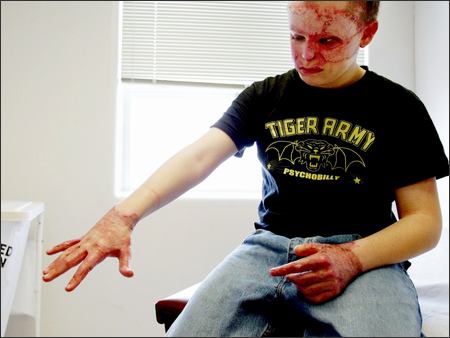 Two faces burned, two lives changed