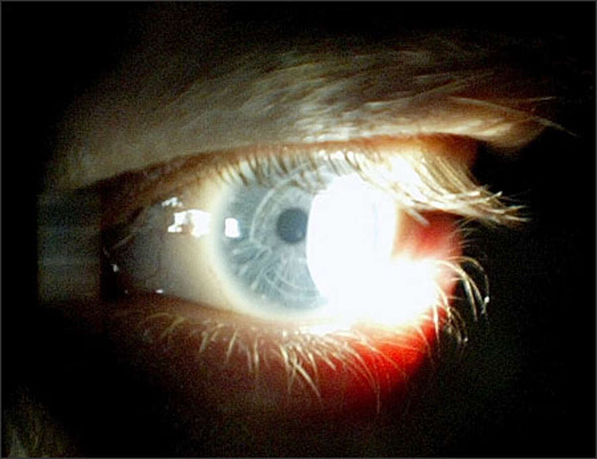 Plastic cones implanted in eye can restore failing sight for some