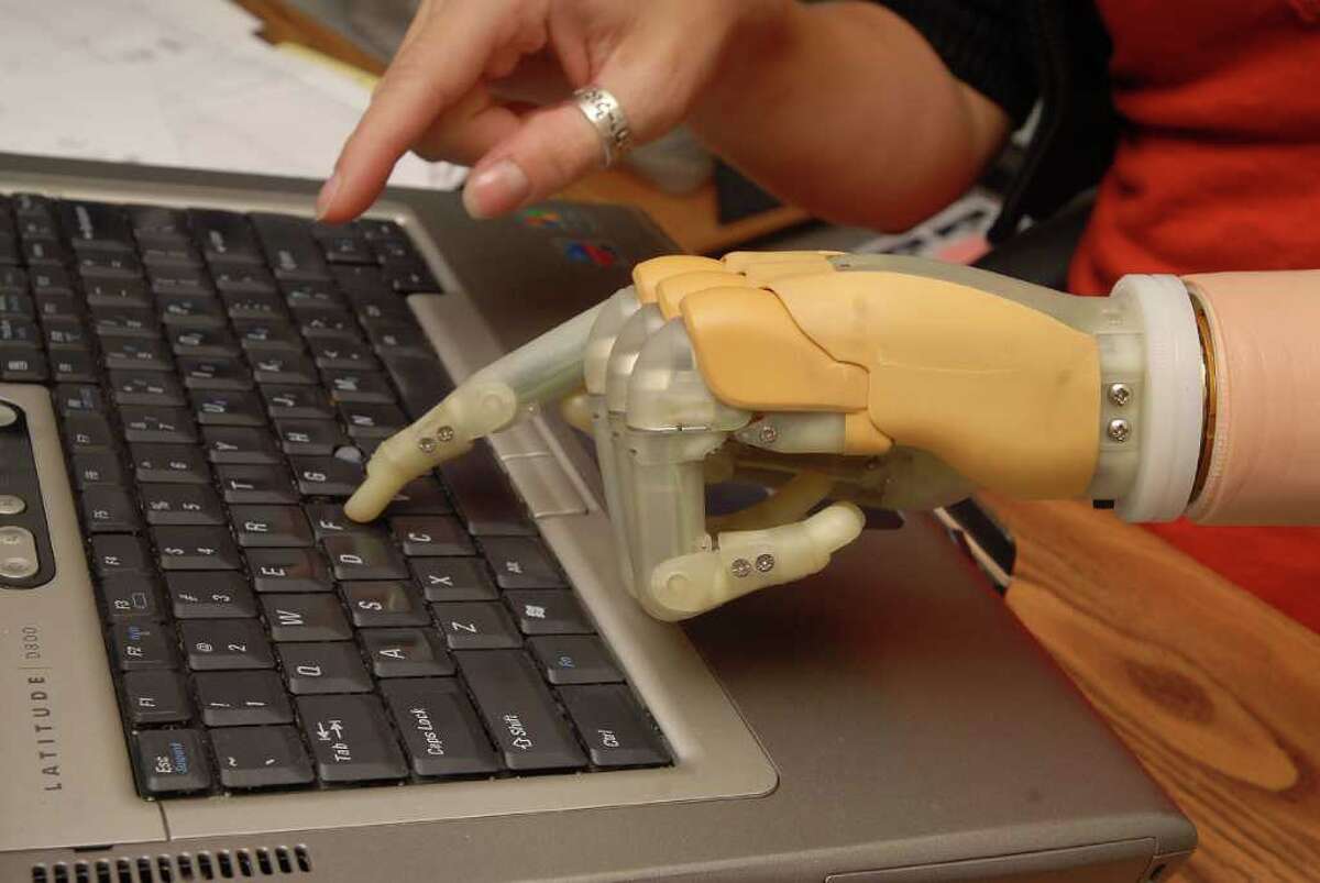 How close are bionics to a real 'Six Million Dollar Man'?