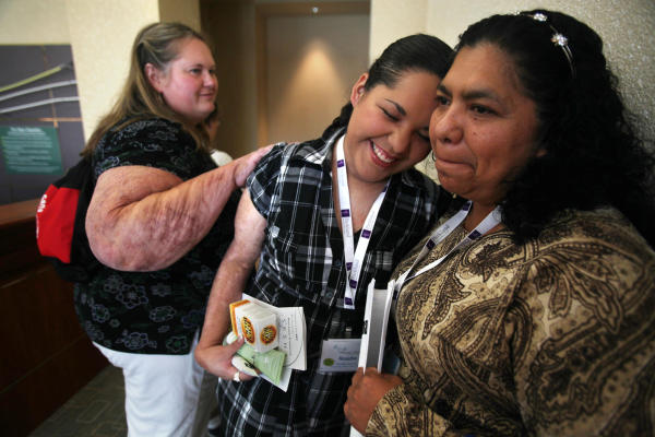 Burn survivors from around world share pain, progress on Isle