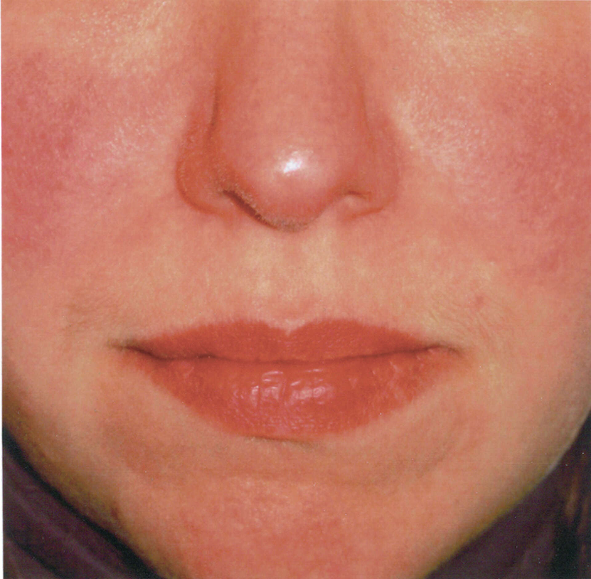 The Rosacea Flush