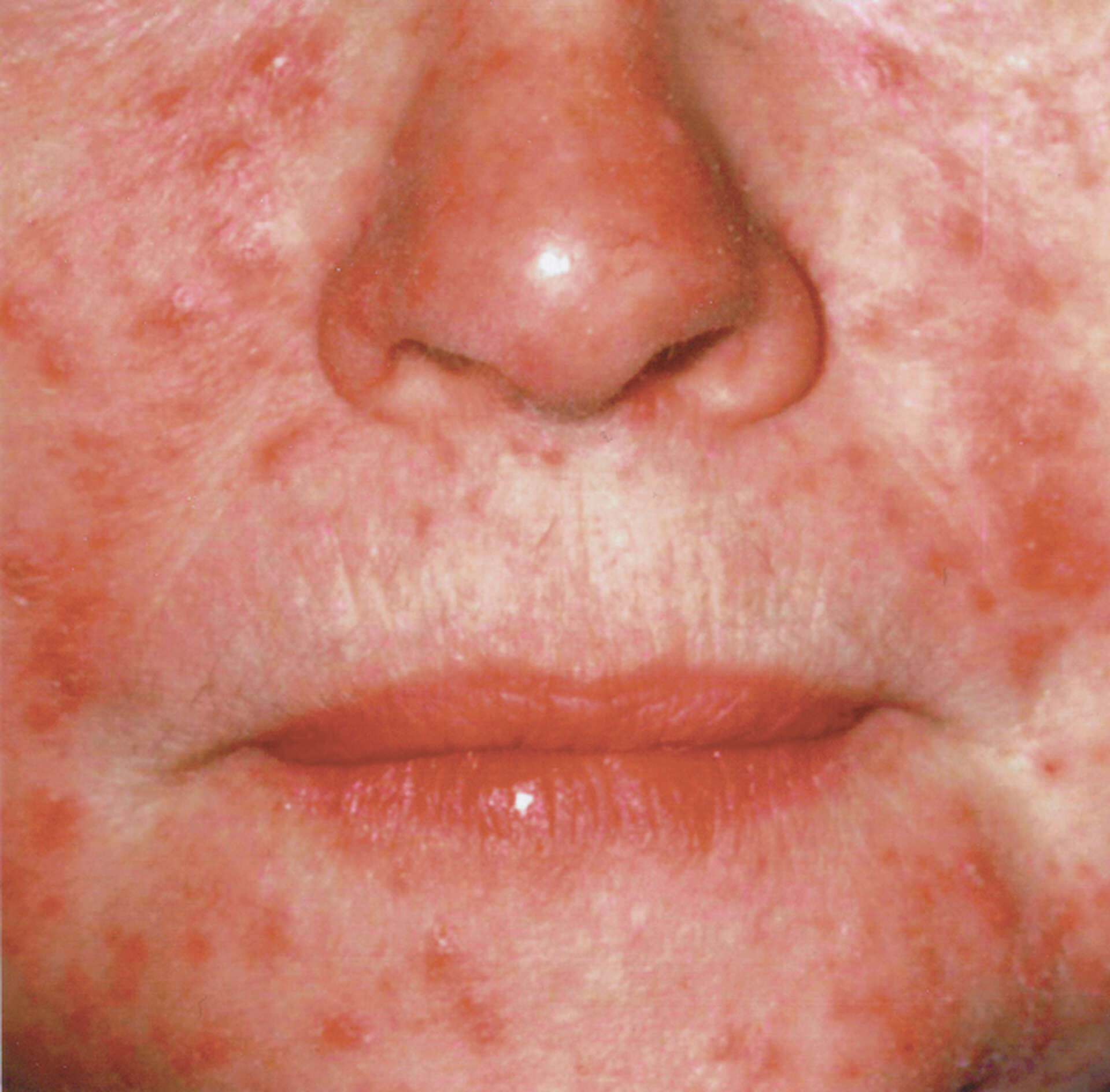 The Rosacea Flush