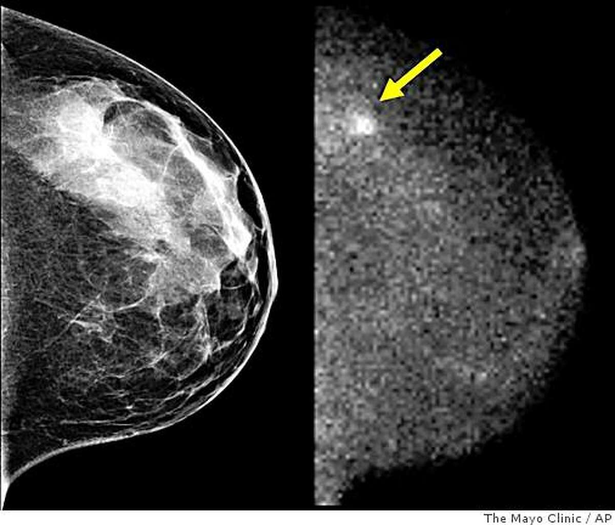 New cancer tool for women with dense breasts