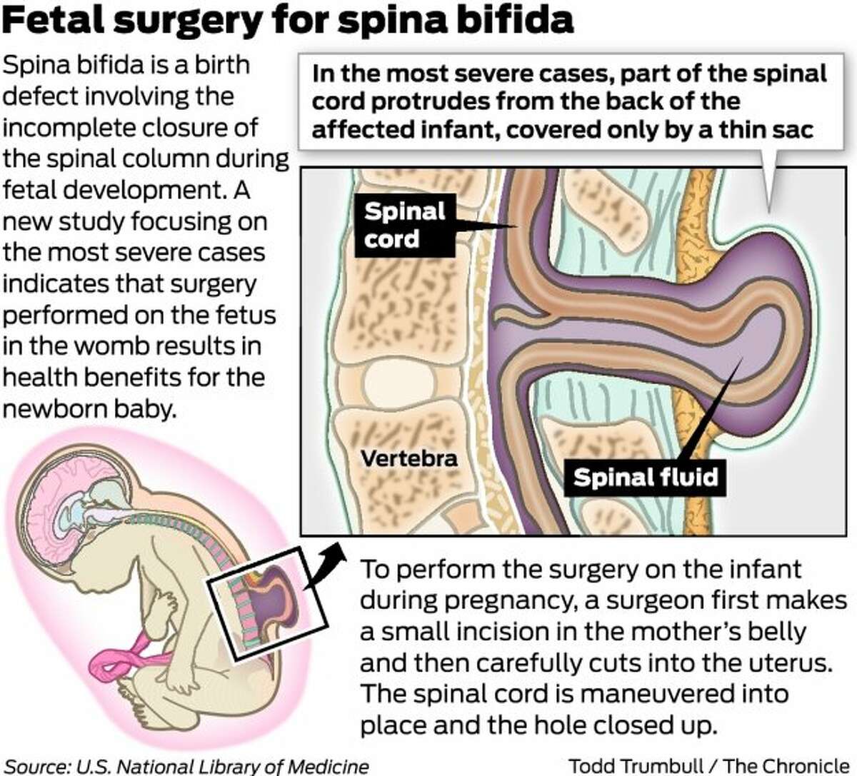 Study vindicates UCSF fetal spine surgery