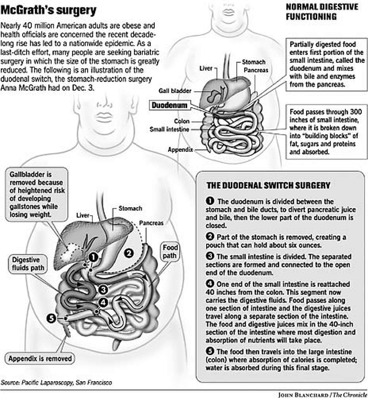 Less is more / Patient says her life is much better after stomach ...