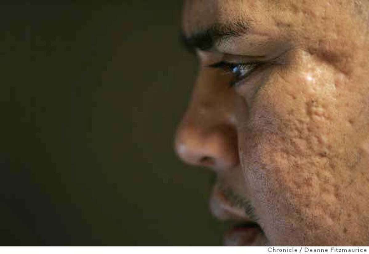 Living with the scars of war / A CONFLICT'S PAINFUL LEGACY: Thousands ...