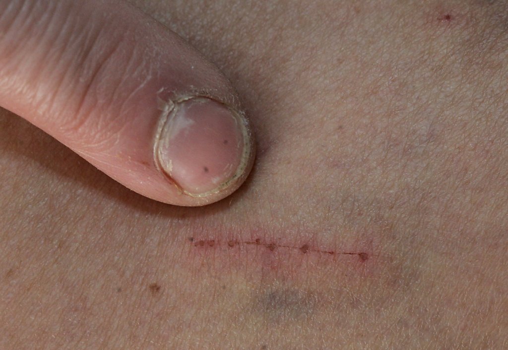 morgellons disease 2024