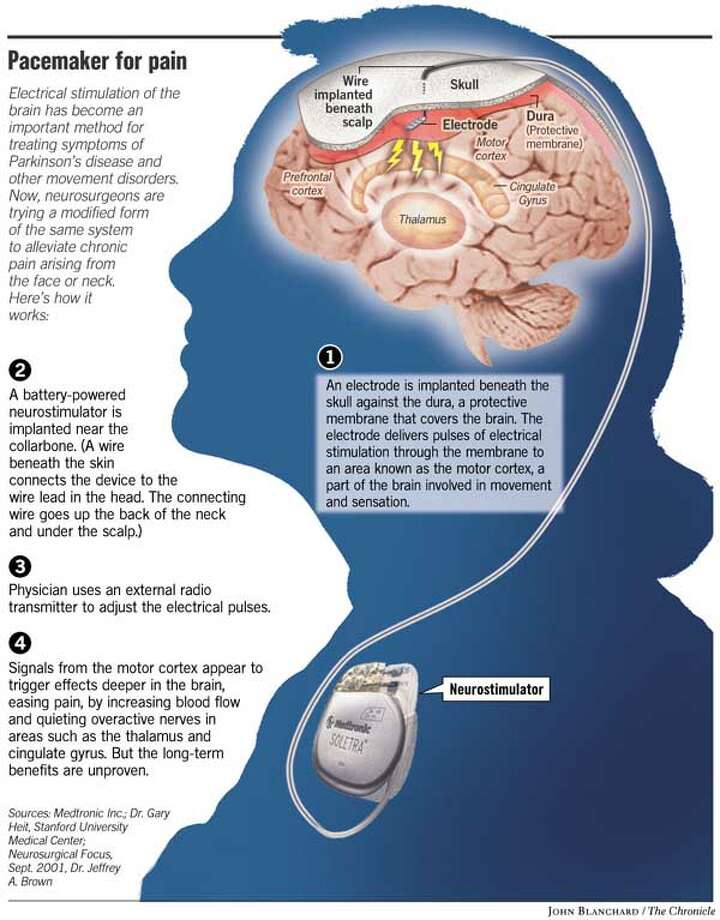 Electrodes in brain fight pain / Surprising effects triggered deep in ...