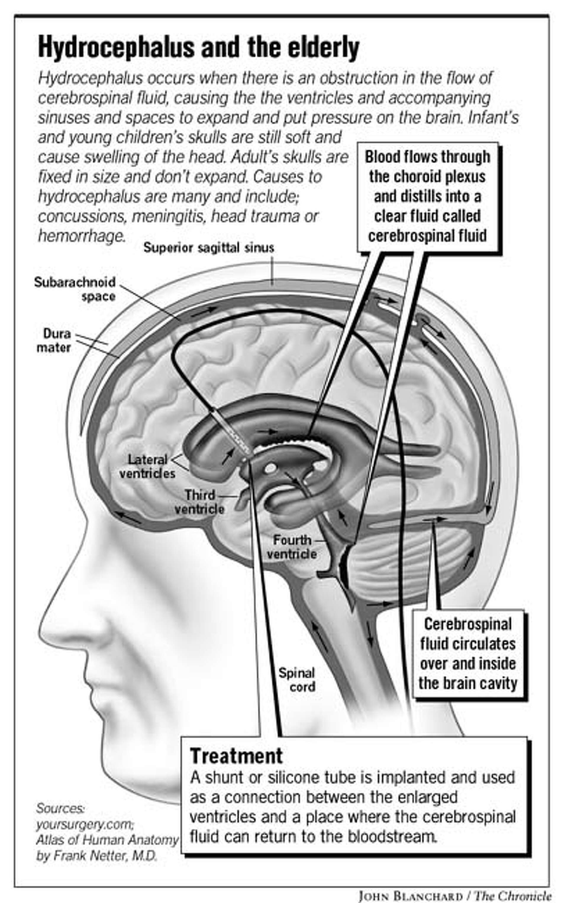 Hidden face of hydrocephalus / Water on the brain, not old age, may be ...